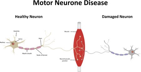 NEURODEGENERATIVE DISEASES